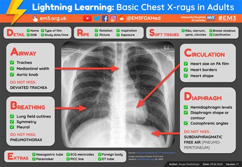lightning learning basic chest x rays in adults — em3