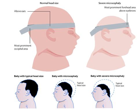 Autosomal Recessive Primary Microcephaly Syndrome