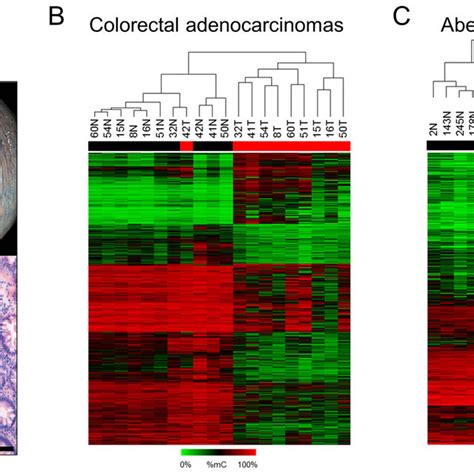 Dna Methylation Patterns In Stage Iii Iv Crcs And Acf A Gross