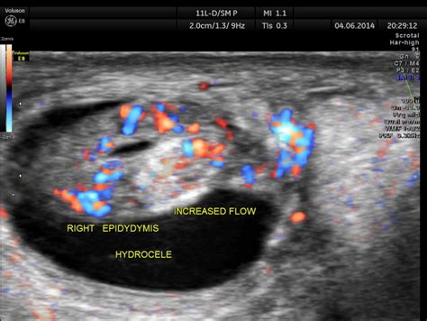 Scrotal Ultrasound Looking Through A Transducer