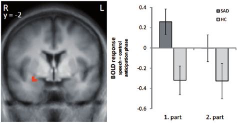 Differential Brain Activation During Speech Vs Control Anticipation In