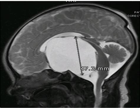Cureus Management Of Arachnoid Cysts A Comprehensive Review