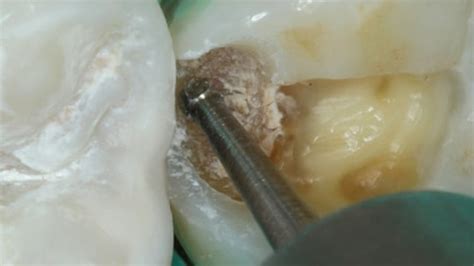 Clinical Treatment Of Deep Caries Decisions In Dentistry