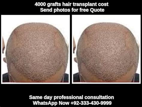 4000 Grafts Hair Transplant Cost In Lahore Pakistan Free Checkup