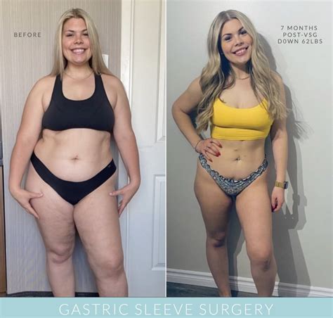 Gastric Sleeve Before And After 2022