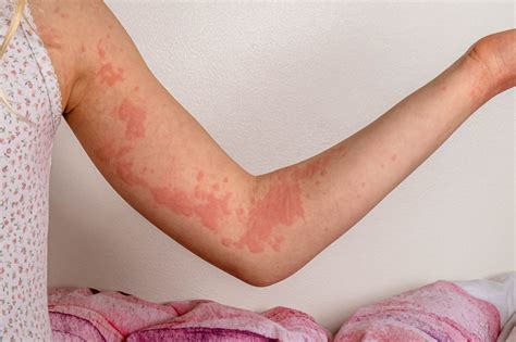 Urticaria Crónica Espontánea Idiopática Erupción Crónica