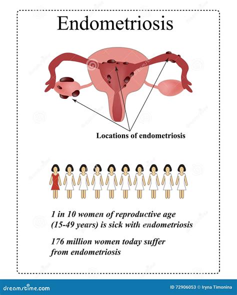 Endometriose Quistos Endometrial O Endométrio Endometriose Das