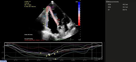 Speckle Tracking Echocardiography Analysis In An Osas Patient The