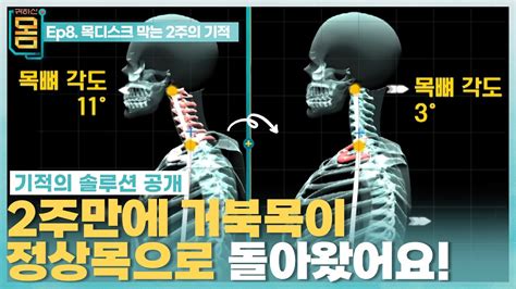[full] 귀하신 몸 8부 목 디스크 막는 2주의 기적 Youtube