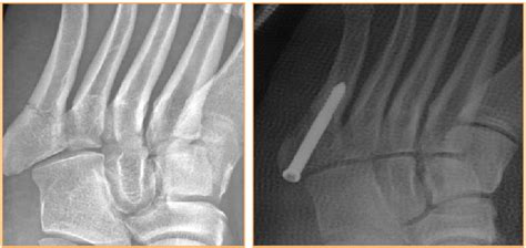Fifth Metatarsal Avulsion Fracture