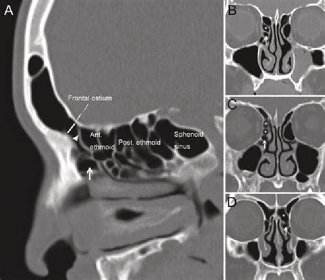 Figure 1 From The Association Of Frontal Recess Anatomy And Mucosal