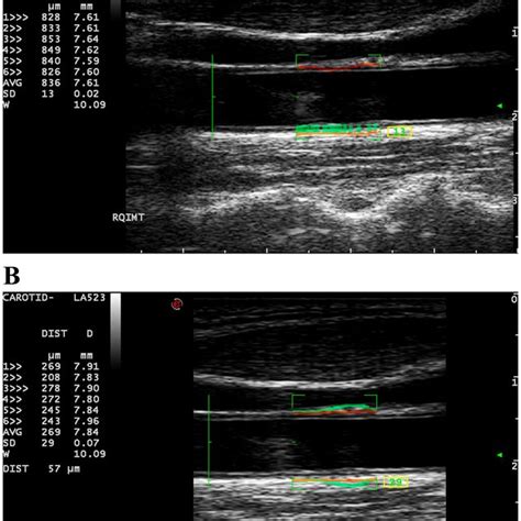 Measurements Of Carotid Intima Media Thickness And Carotid Arterial