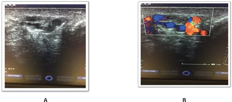 Figure 1 From The Scrotal Colour Doppler Ultrasound Findings In