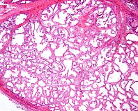 Benign Prostatic Hyperplasia Light Micrograph Stock Image C051
