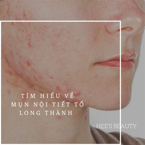 Tìm Hiểu Về Mụn Nội Tiết Tố Long Thành Hees Beauty Clinic
