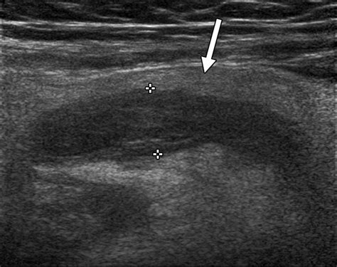 Value Of Focused Appendicitis Ultrasound And Alvarado Score In