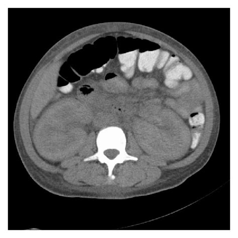 Computed Tomography Ct Scan Of The Abdomen Pelvis Without Contrast