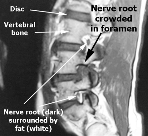 Foraminal Stenosis Mri
