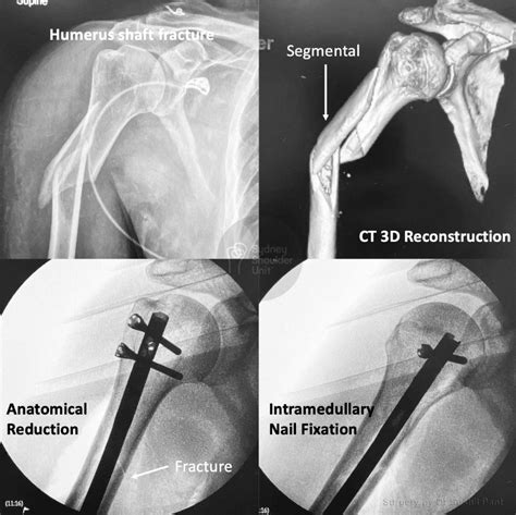 Proximal Humerus Fracture Presentation