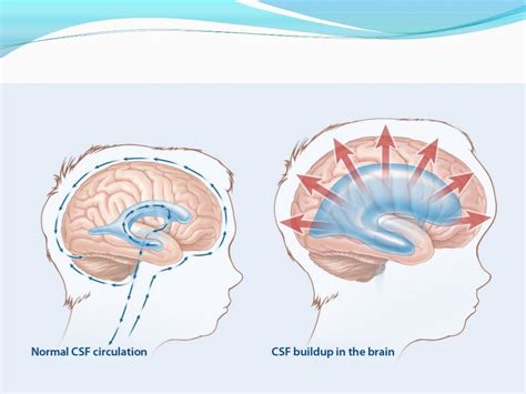 Hydrocephalus And Spina Bifida