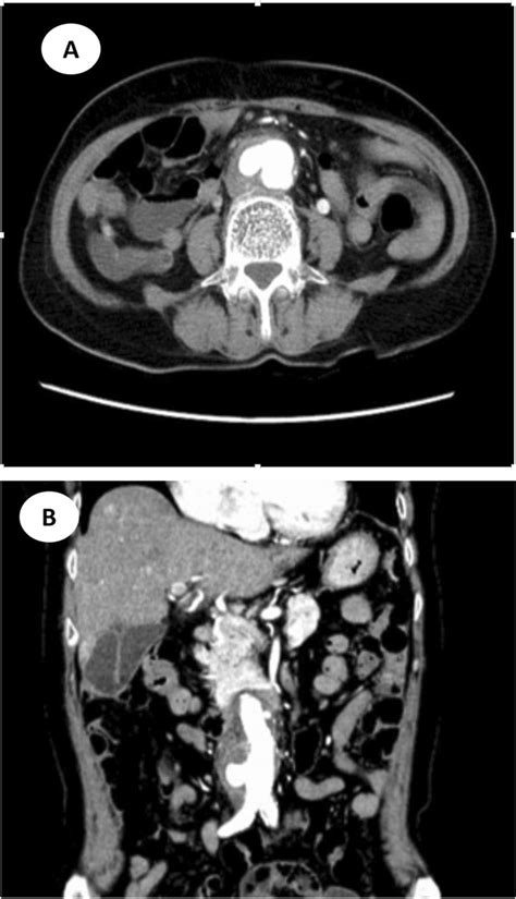 Computed Tomographic Angiography Cta Of Abdomen Before Surgery A