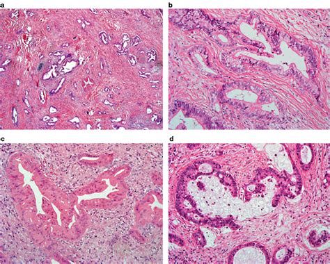 Morphology Of Bile Duct Type Intrahepatic Cholangiocarcinoma A On