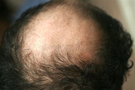 Hair Loss Explained How And Why Men Go Bald The Independent The