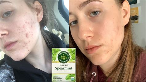 I Drank Spearmint Tea For 4 Months To Clear My Cystic Hormonal Acne