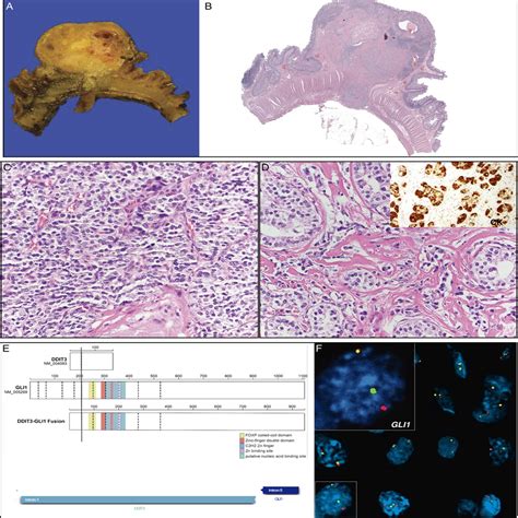 Gli1 Rearranged Enteric Tumor Expanding The Spectrum Of Gas The