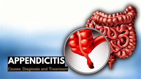 Appendicitis Causes Signs And Symptoms Diagnosis And Treatment