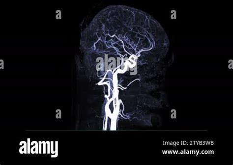 Cta Brain Or Computed Tomography Angiography Of Cerebral And Common