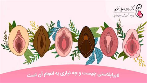لابیاپلاستی چیست و چه نیازی به انجام آن است سوالات متداول دکتر