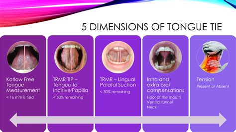 Diagnosing A Posterior Tongue Tie