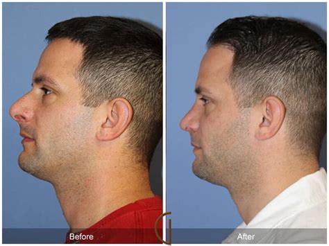 Male Rhinoplasty Before And After Photos From Dr Kevin Sadati