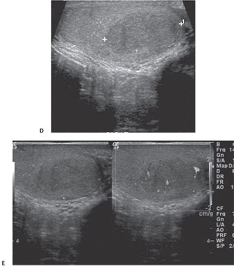 145 Left Malignant Germ Cell Tumor Of The Testis With Metastatic Bulky