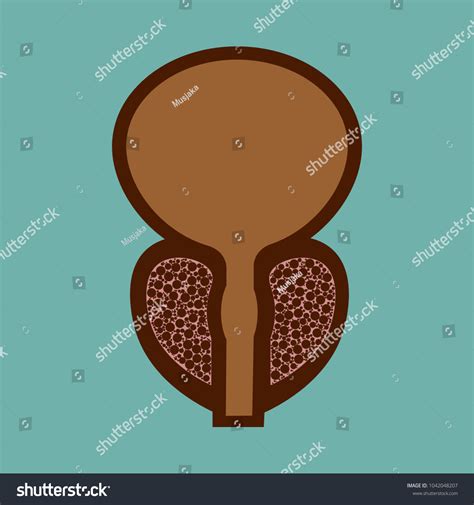 Vector Illustration Prostatitis Sexual Infections Prostate Stock Vector