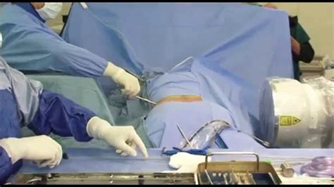 Transforaminal Endoscopic Lumbar Discectomy Youtube