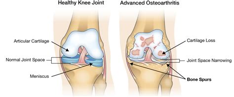 Successful Osteoarthritis Therapy Bms Matrix