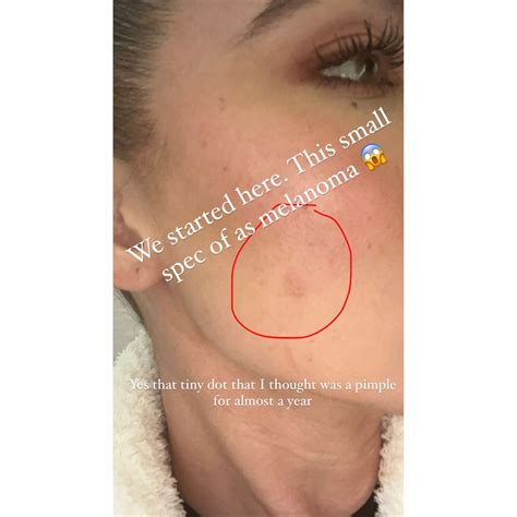 Khloe Kardashian Shares Before After Photos Of Her Cheek Post Cancer