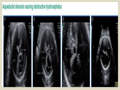Presentation1 Pptx Ultrasound Examination Of The 2nd And 3rd Trimester