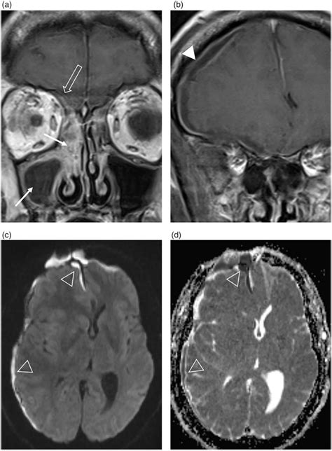 Acute Bacterial Sinusitis Complicated By An Intracranial Subdural