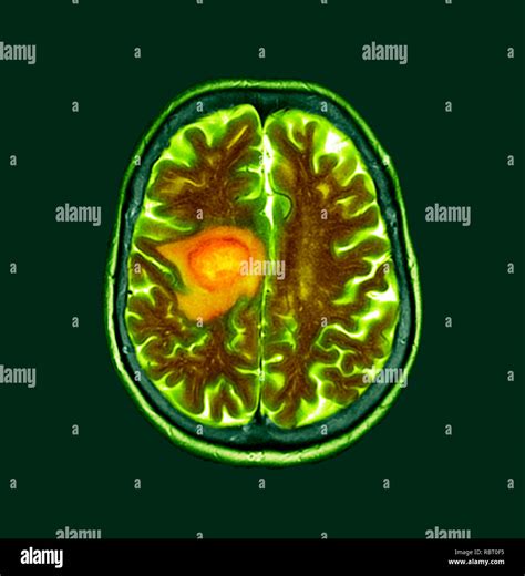 Glioblastoma Brain Cancer Coloured Computed Tomography Ct Scan Of A