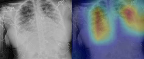 classification of chest x rays using tensorflow 2
