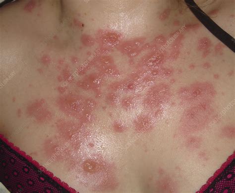 Erythema Multiforme Rash Stock Image C047 3500 Science Photo Library