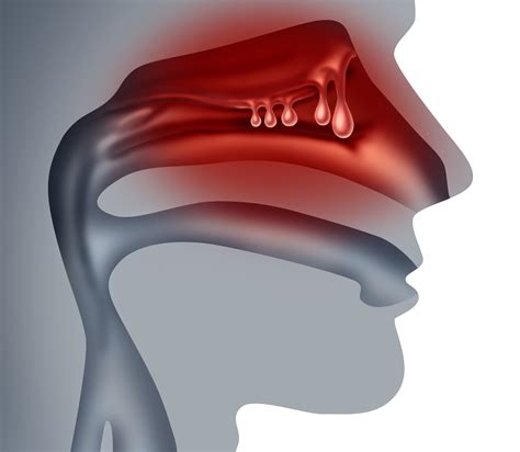 Dupilumab Effective Safe In Chronic Rhinosinusitis With Nasal Polyps
