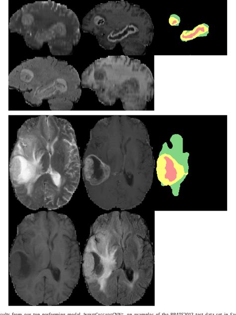 [pdf] brain tumor segmentation with deep neural networks semantic scholar