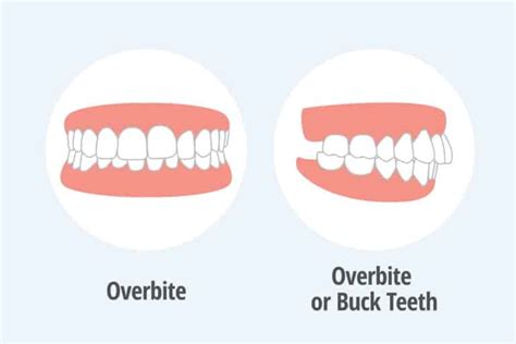 Overbite Vs Normal Bite Differences Causes And Treatment
