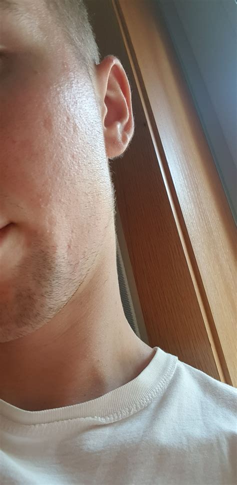 Advice On Acne Scars W Limited Options Pics Scar Treatments Acne