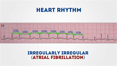 How To Read An Ecg Ecg Interpretation Ekg Geeky Medics 2700 Hot Sex