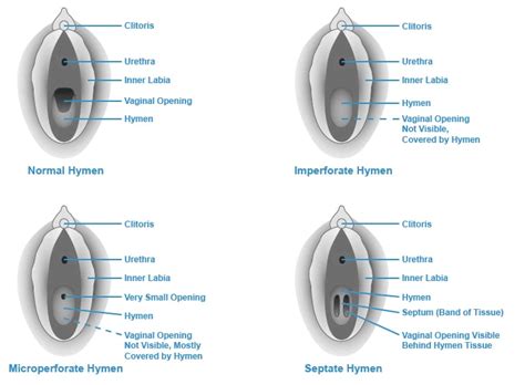 Hymens Types Of Hymens Center For Young Womens Health